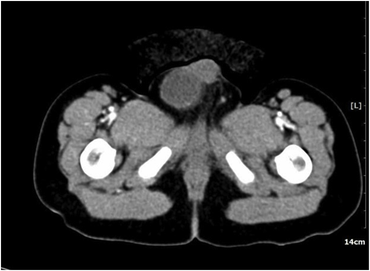 Abdominoscrotal Hydrocele A Case Report Pmc