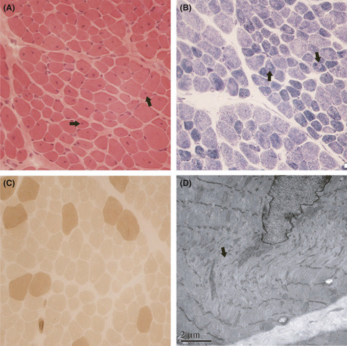 Centronuclear myopathy due to a de novo nonsense variant and a maternally inherited splice‐site ...