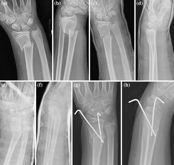 Isolated distal radial metaphyseal fractures with an intact ulna: risk factors for loss of ...