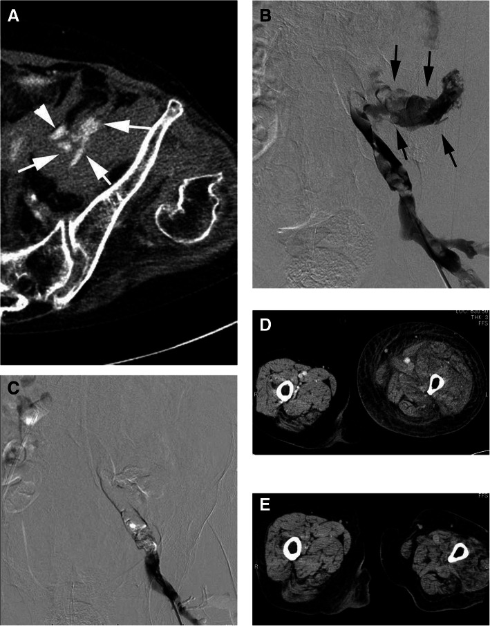 Embolization for massive bleeding due to spontaneous left external iliac vein rupture: report of ...