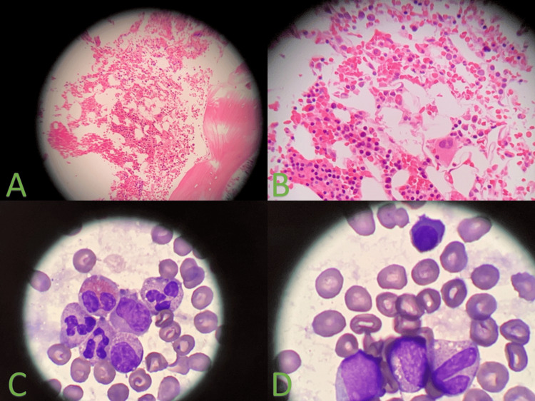 Severe B12 Deficiency Causing a Maturation Defect Mimicking ... Severe B12 Deficiency Causing a Maturation Defect Mimicking ...