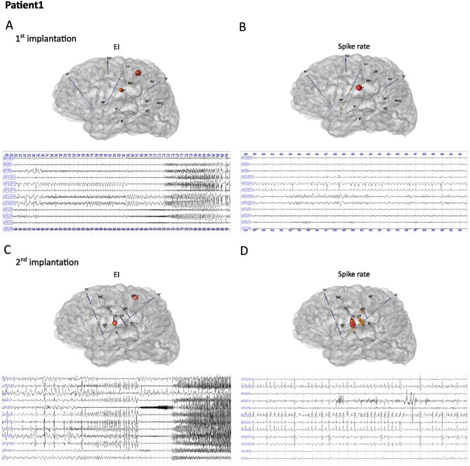 Combining independent component analysis and source localization for ...