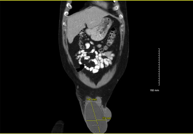 Deflate Gate Conservative Management Of A Large Ruptured Hydrocele Pmc