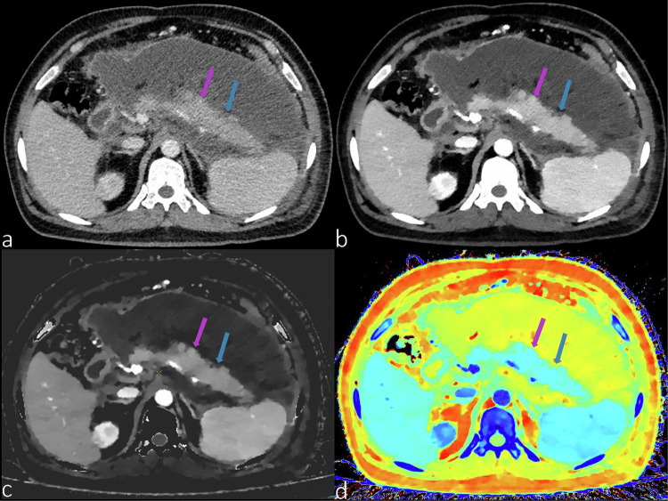 The Clinical Applications Of Dual Layer Spectral Detector Ct In Digestive System Diseases Pmc
