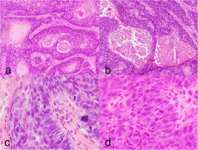 Basaloid Squamous Cell Carcinoma of Tonsil: an Unusual and Aggressive Variant - PMC
