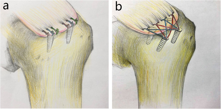Biomechanical comparison between single-row with triple-loaded suture anchor and suture-bridge ...