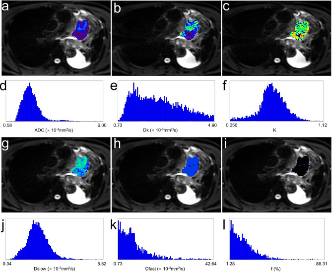 Histogram analysis of multiple diffusion models for predicting advanced non-small cell lung ...