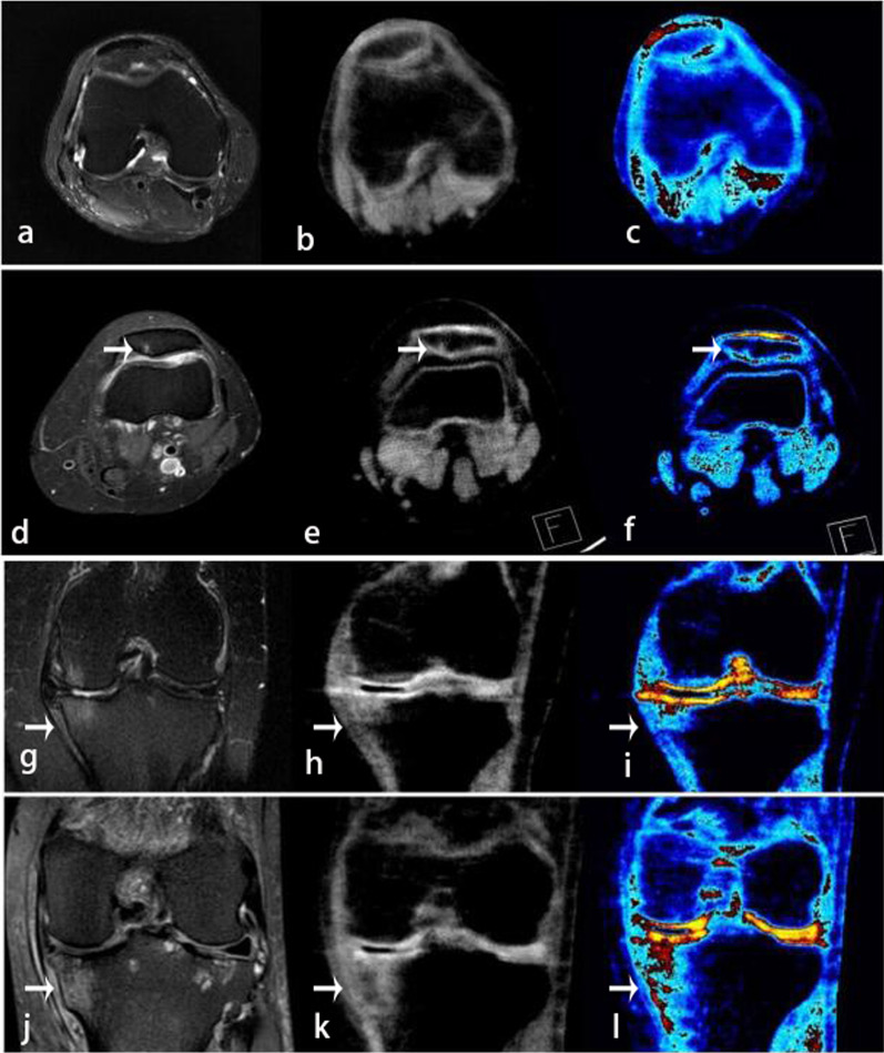 Dual-energy CT virtual non-calcium: an accurate method for detection of knee osteoarthritis ...