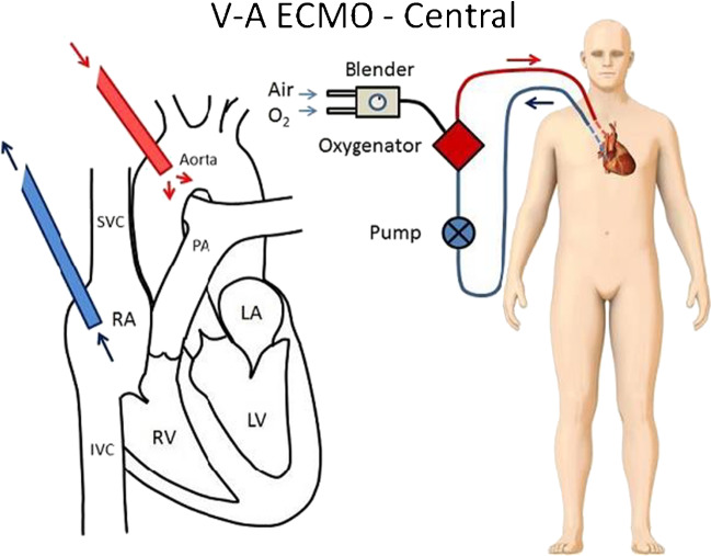 Cannulation strategies for extracorporeal membrane oxygenation - PMC