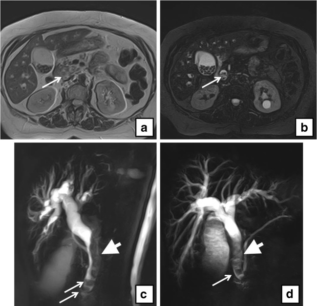 Routine MRCP in the management of patients with gallbladder stones awaiting cholecystectomy: a ...