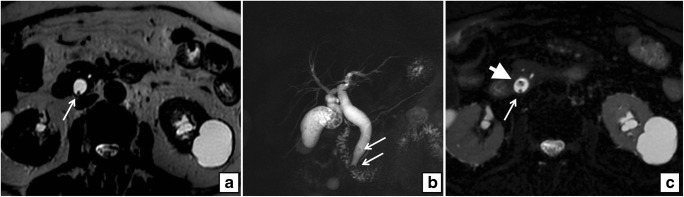 Routine MRCP in the management of patients with gallbladder stones awaiting cholecystectomy: a ...