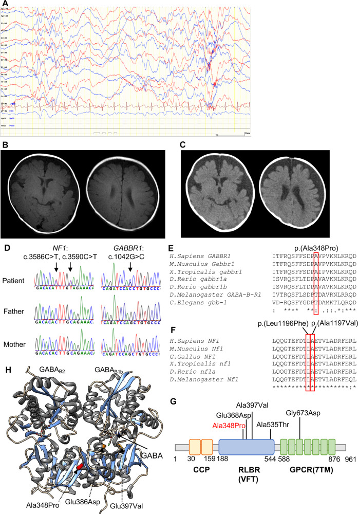 A case of infantile spasms with three possibly pathogenic de novo missense variants in NF1 and ...