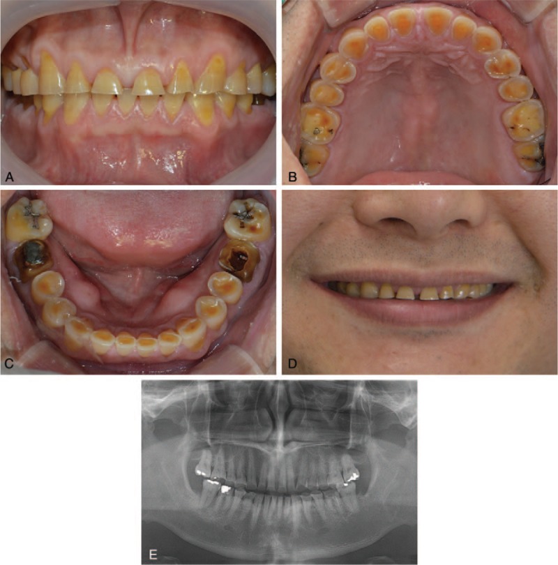 Contemporary Full Mouth Rehabilitation Using A Digital Smile Design In