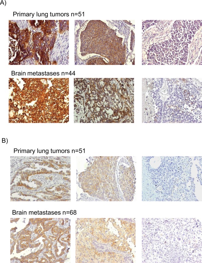 EGFR and HER3 expression in circulating tumor cells and tumor tissue from non-small cell lung ...