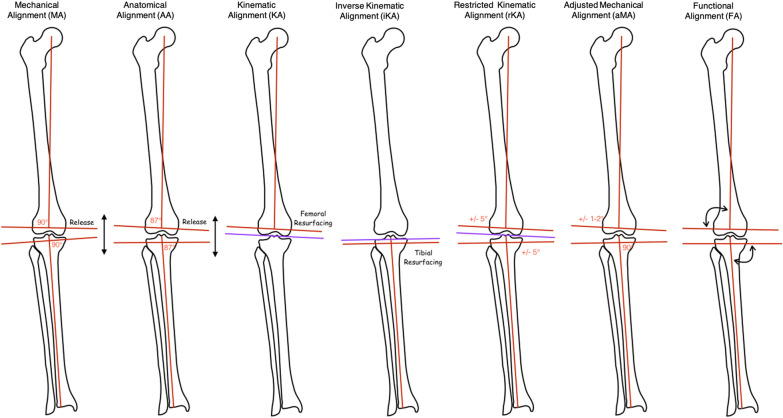 Coronal alignment in total knee arthroplasty: a review - PMC