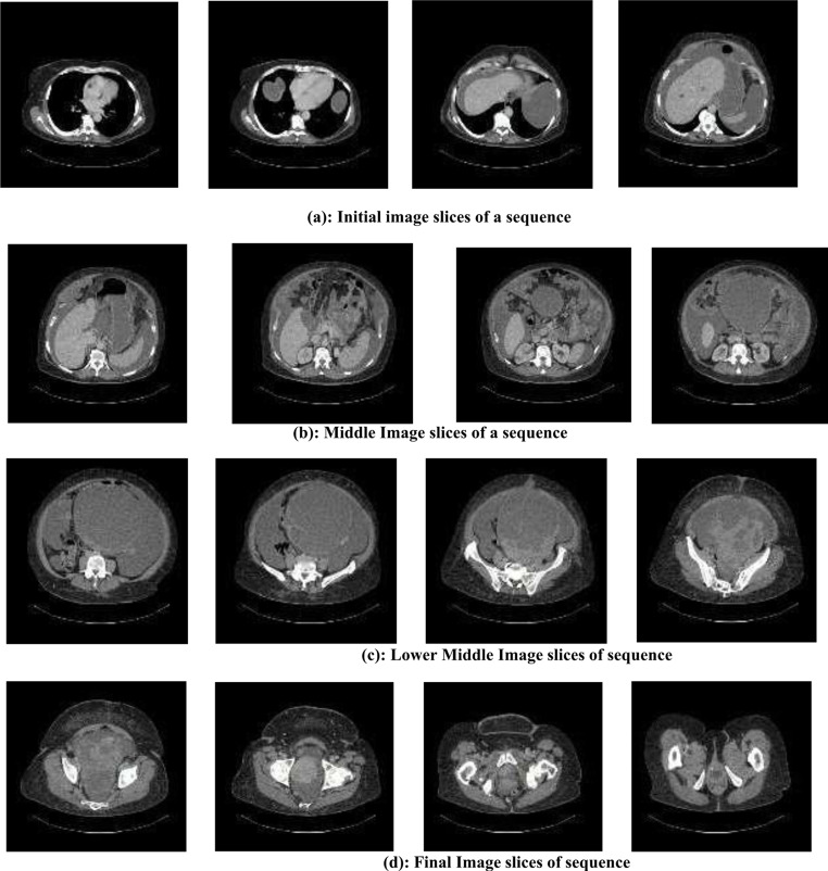 Optimising Ovarian Tumor Classification Using A Novel Ct Sequence Selection Algorithm Pmc