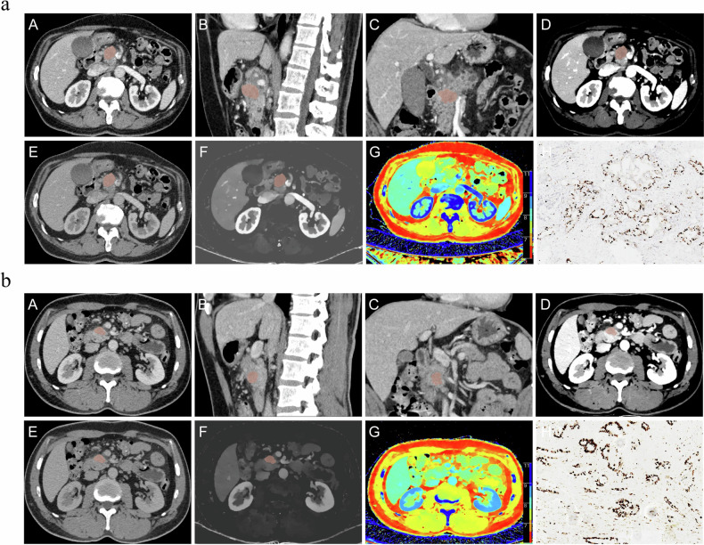 Development and validation of a model based on preoperative dual-layer detector spectral ...