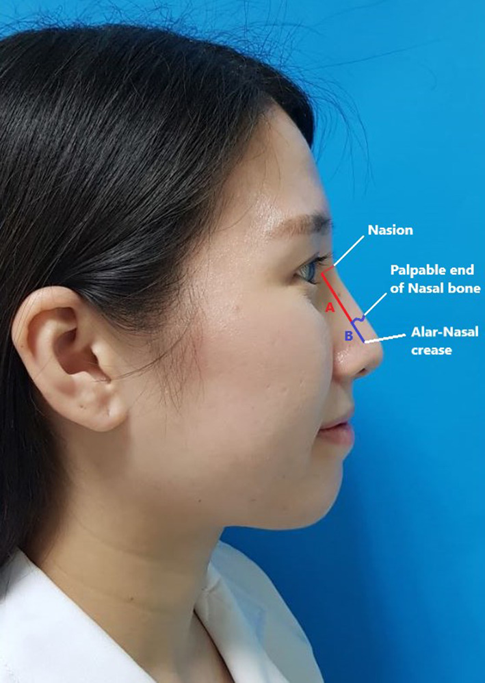 Nasal Sidewall Dimensions in the Asian Nose: A Thai Cadaveric Study - PMC