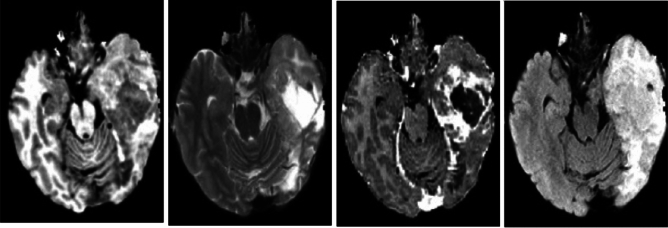 Automatic brain-tumor diagnosis using cascaded deep convolutional ...