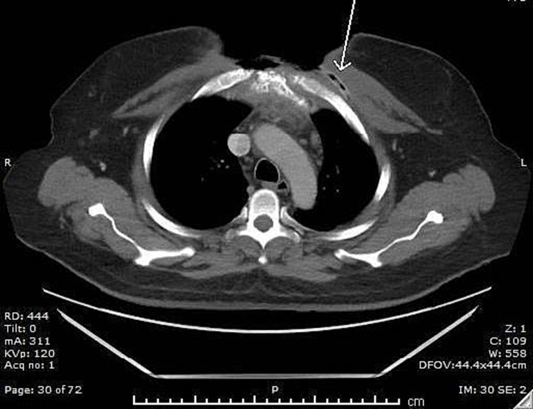 Primary Sternal Osteomyelitis A Case Report Pmc