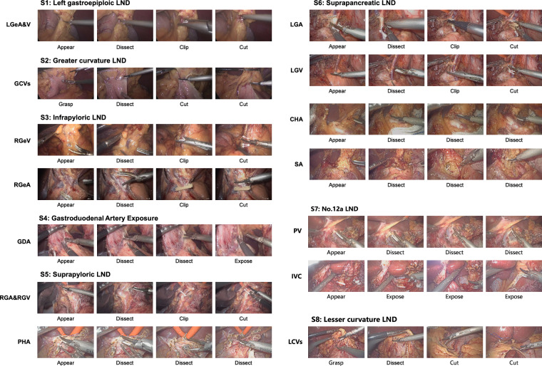 Dynamic key vascular anatomy dataset for D2 lymph node dissection during laparoscopic gastric ...
