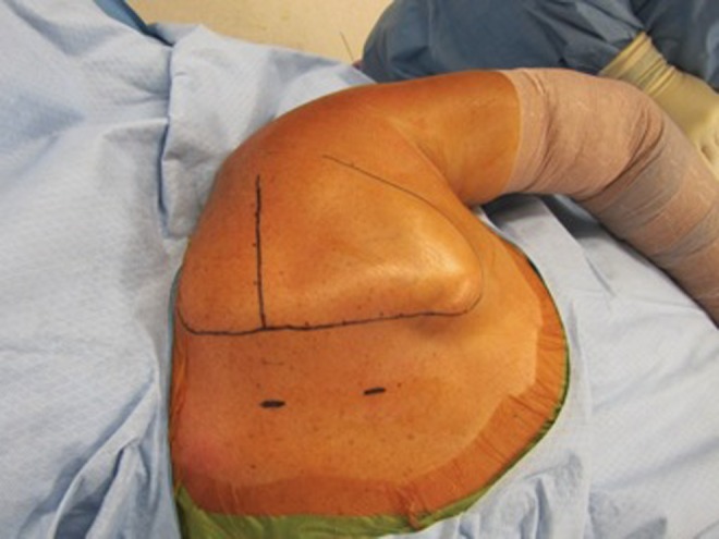 Functional Outcomes After Arthroscopic Scapulothoracic Bursectomy And