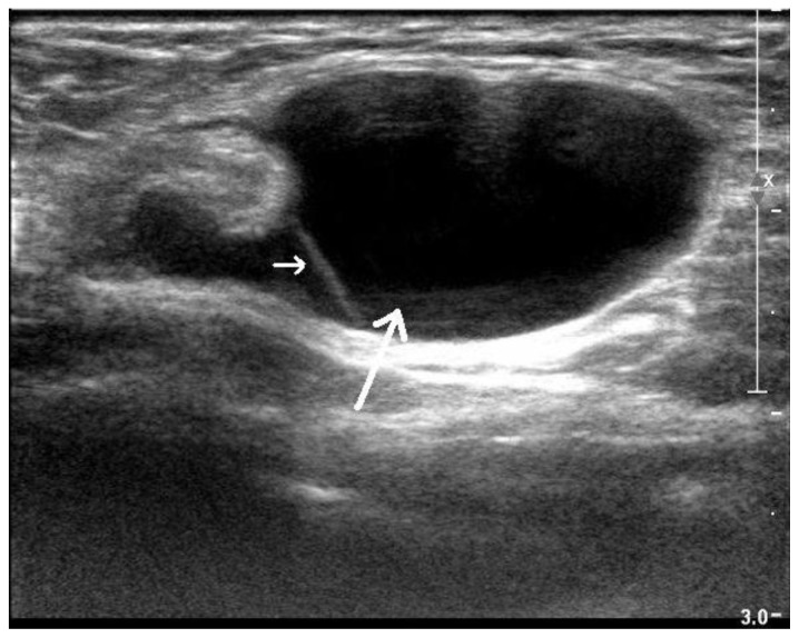 Hydrocele Of The Canal Of Nuck Value Of Radiological Diagnosis Pmc