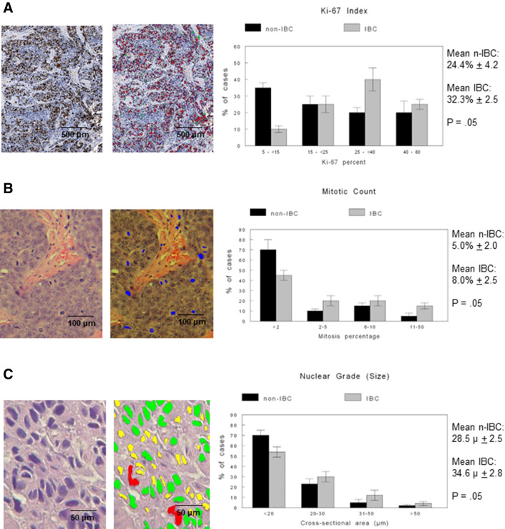 Geometric tumor embolic budding characterizes inflammatory breast cancer - PMC