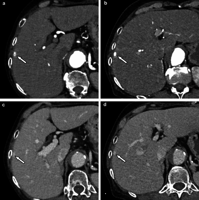 Photon Counting Ct Technical Features And Clinical Impact On Abdominal