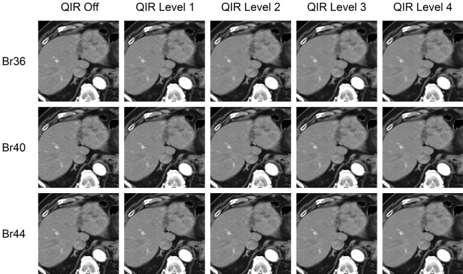 Photon Counting Ct Technical Features And Clinical Impact On Abdominal