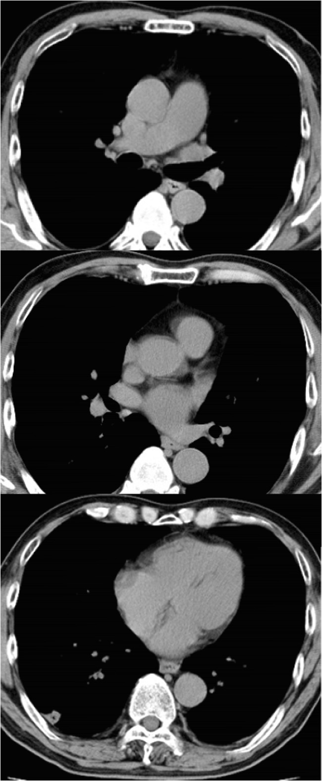Occult Multiple Mediastinal Lymph Node Metastasis and Malignant Pleural Effusion Due to Signet ...