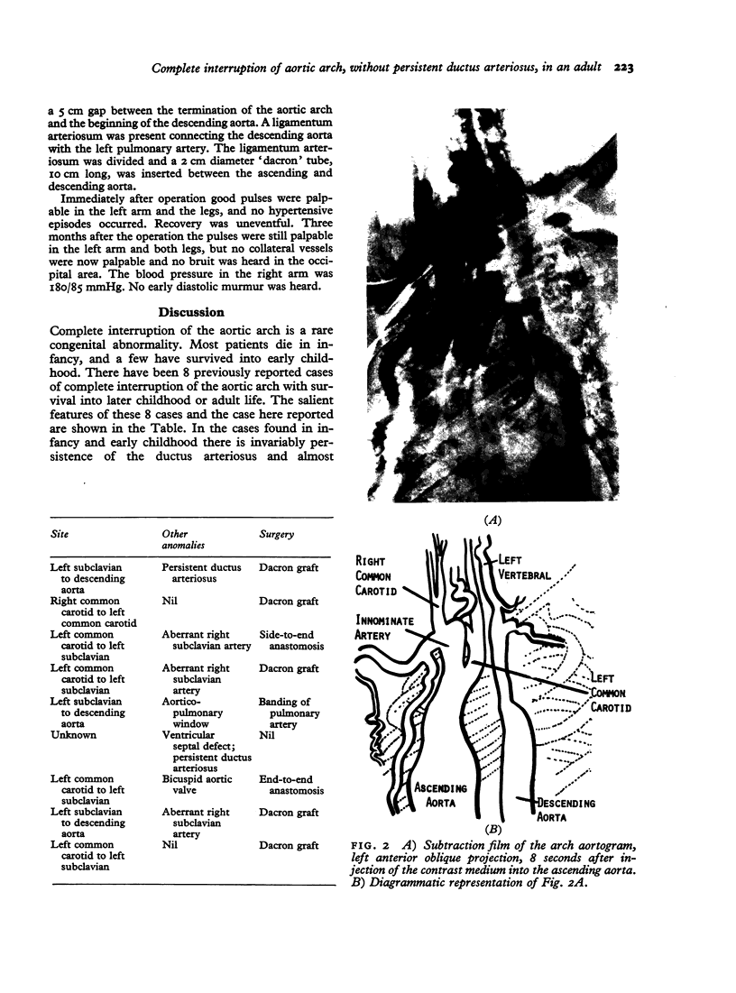 Complete Interruption Of Aortic Arch, Without Persistent Ductus