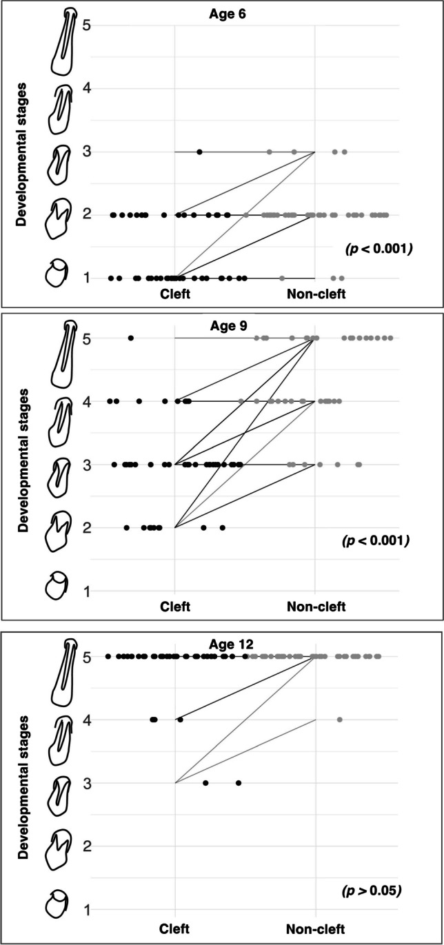Developmental characteristics of the permanent upper lateral incisor in unilateral cleft lip and ...