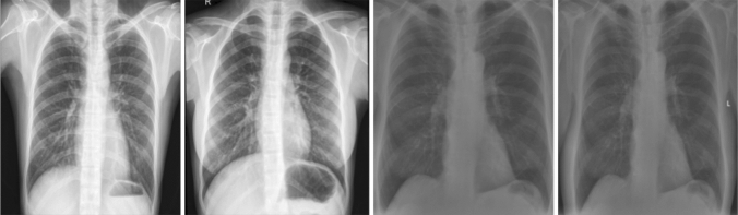 A multichannel EfficientNet deep learning-based stacking ensemble ...