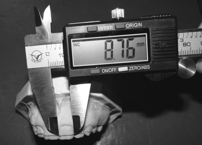 Comparative Measurement of Mesiodistal Width of Six Anterior Maxillary ...