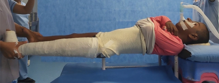 Hip Spica Table: A Technical Note - PMC