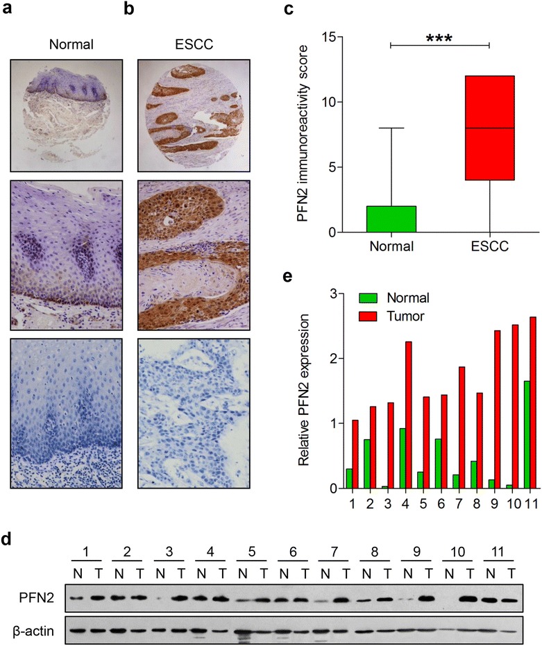 PFN2, a novel marker of unfavorable prognosis, is a potential therapeutic target involved in ...