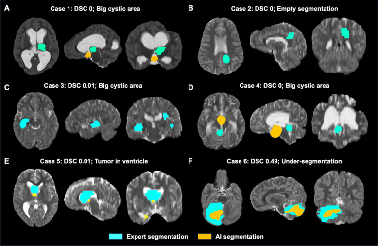 Expert-level pediatric brain tumor segmentation in a limited data ...