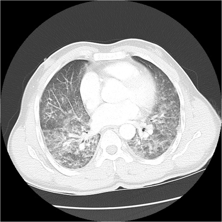 Varicella Pneumonia in an Immunocompetent Adult - PMC