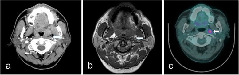 The value of CT, MRI, and PET-CT in detecting retropharyngeal lymph node metastasis of head and ...