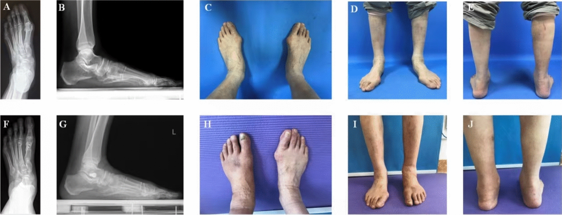 Subtalar arthroereisis for simultaneous treatment of flexible pes planus during surgical ...