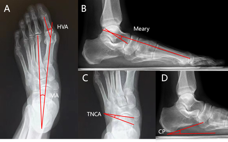 Subtalar arthroereisis for simultaneous treatment of flexible pes planus during surgical ...