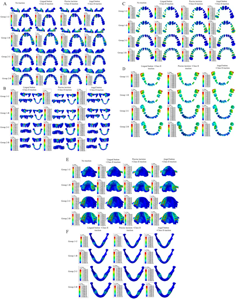 Effects of maxillary molar distalization using clear aligners during the mixed dentition and ...