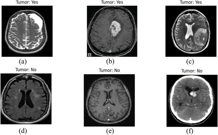 Enhancing brain tumor detection in MRI images through explainable AI using Grad-CAM with Resnet ...