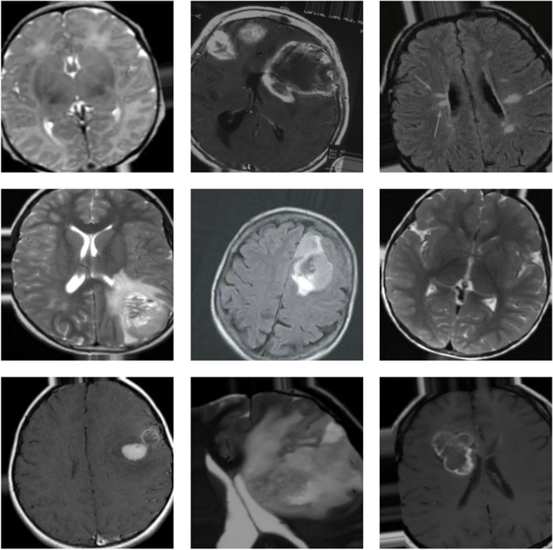 Enhancing brain tumor detection in MRI images through explainable AI using Grad-CAM with Resnet ...