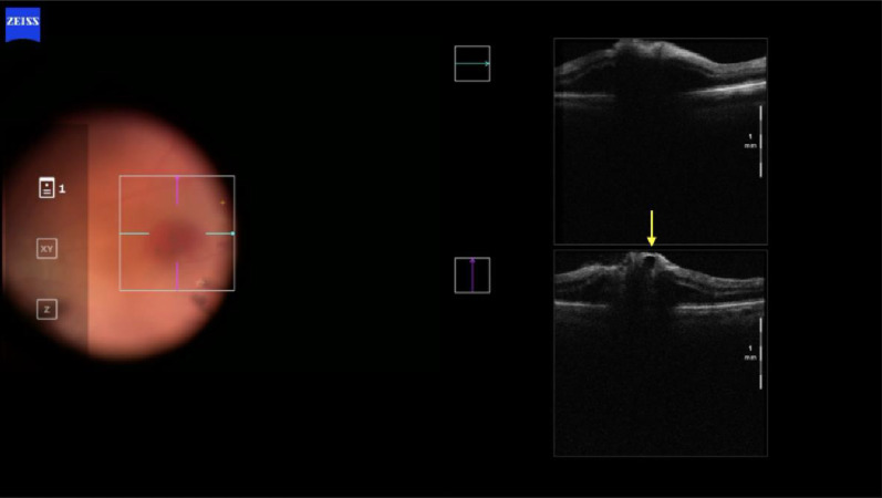 New surgery technique for refractory macular hole guided by intraoperative OCT: free internal ...
