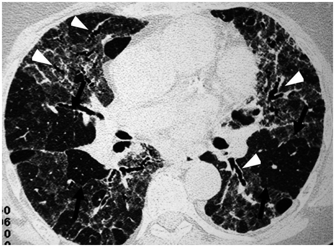 Non Infectious Granulomatous Lung Disease Imaging Findings With Pathologic Correlation Pmc