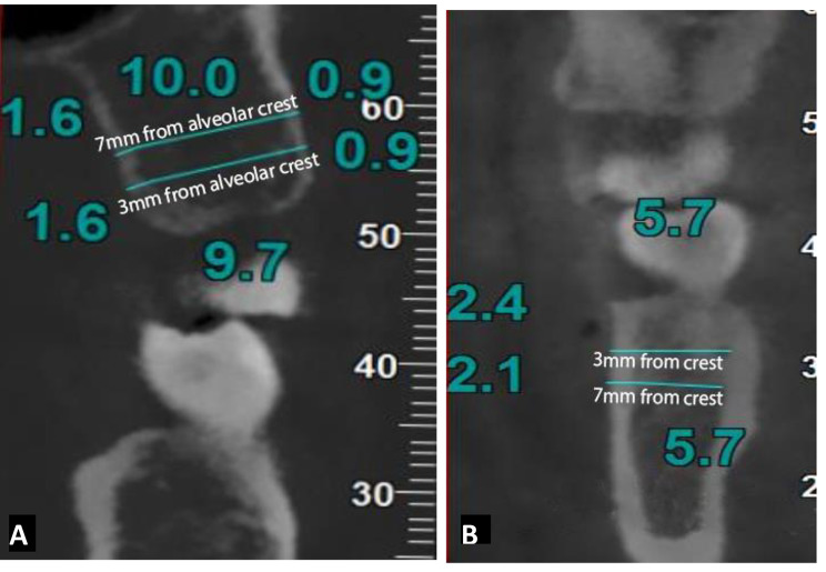 Three-dimensional evaluation of the cortical and cancellous bone ...