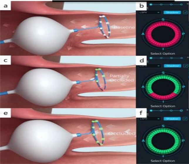 Feasibility study of cryoballoon ablation for atrial fibrillation with KODEX-EPD: a single ...