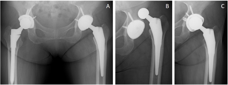 Dual Mobility Acetabular Construct With Freedom Constrained Liner For Treatment Of Recurrent